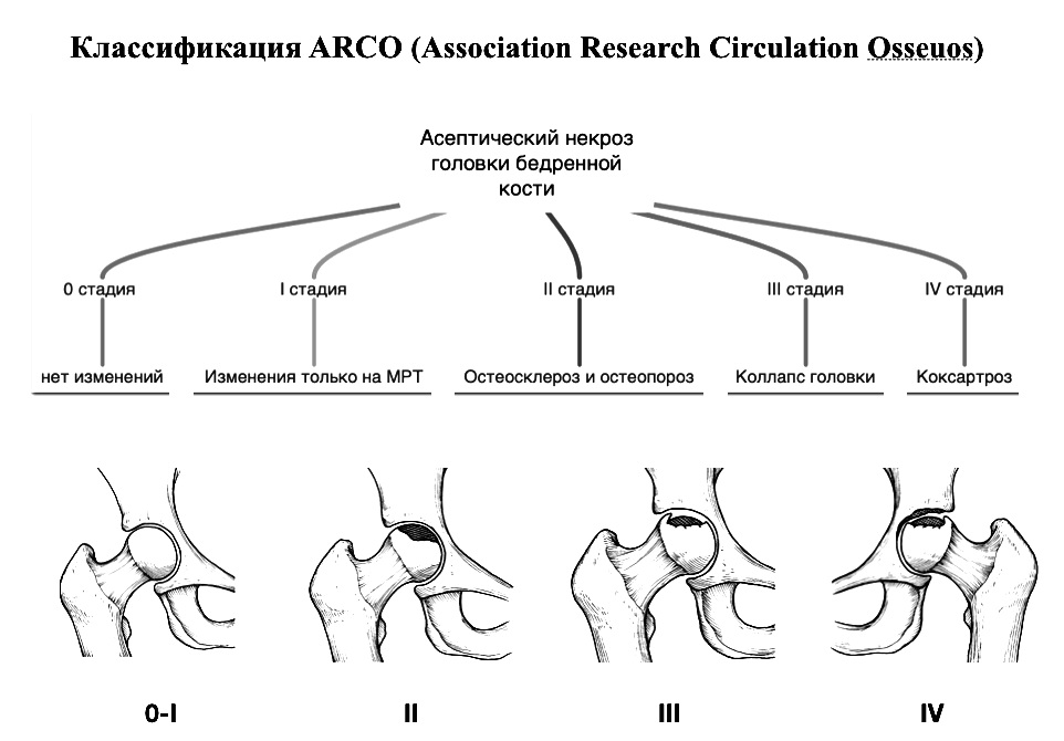 Стадии асептического некроза головки бедренной кости